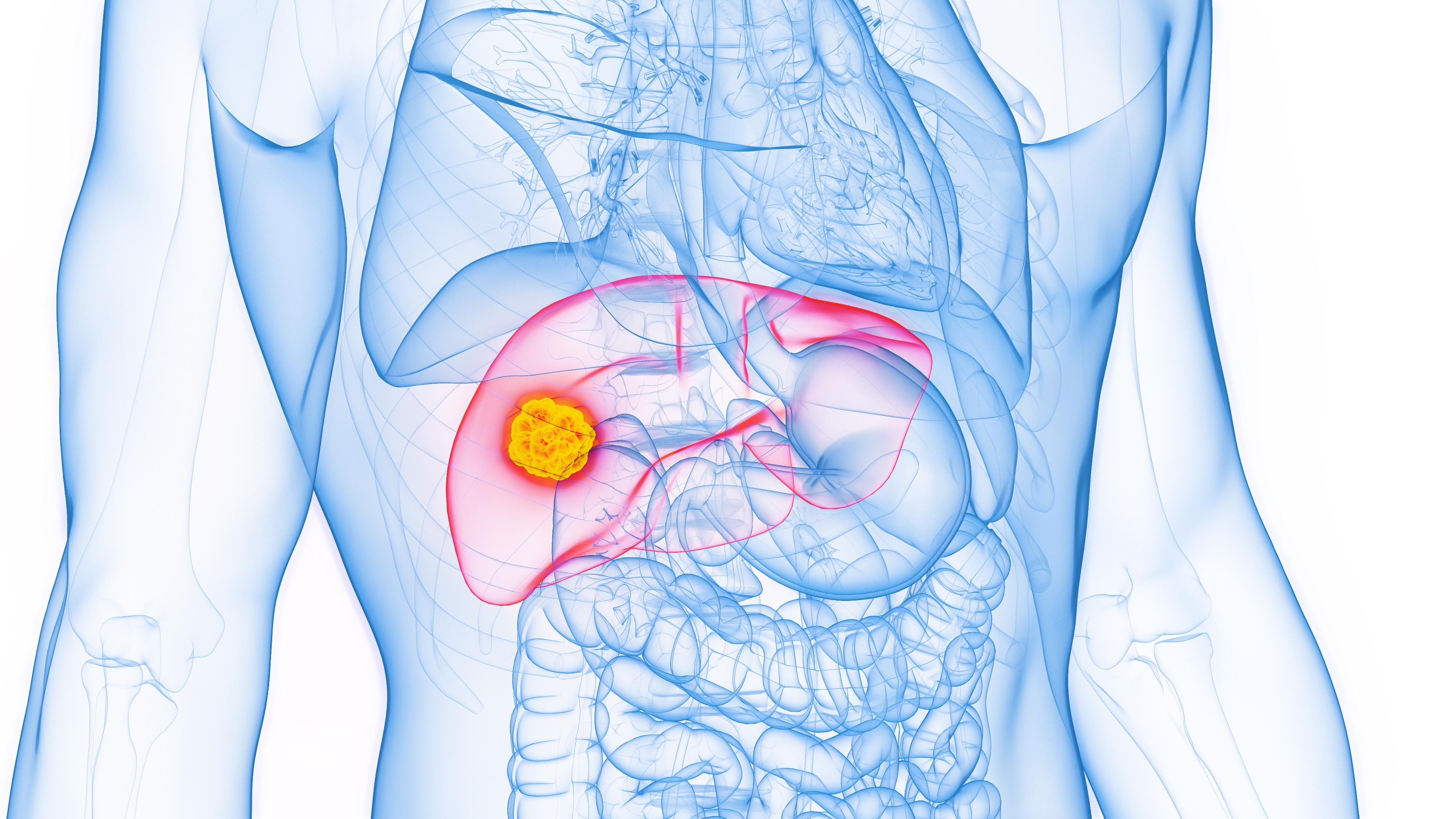 Immunotherapy Plus TACE A New Standard for Unresectable Liver Cancer ...