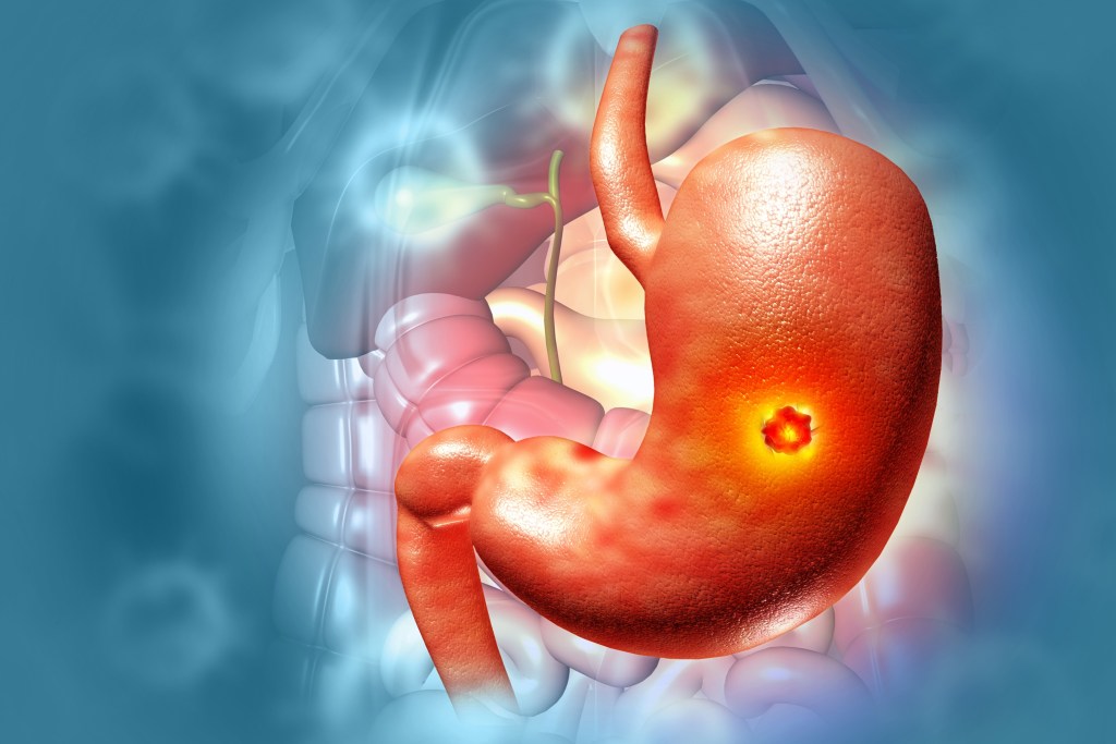 FDA Approves Tevimbra Combination for Gastric or Gastroesophageal ...