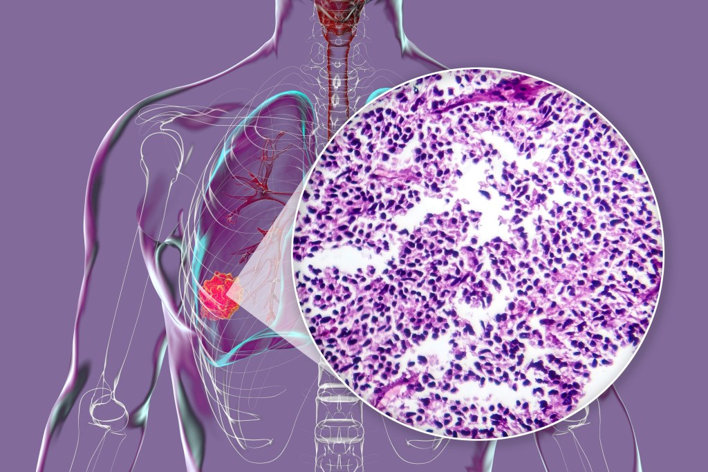 FDA Approves New Maintenance Treatment for Small Cell Lung Cancer ...