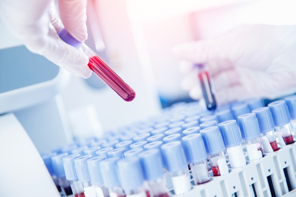 FDA Approves New Blood Test to Help Diagnose High-Grade Prostate Cancer ...